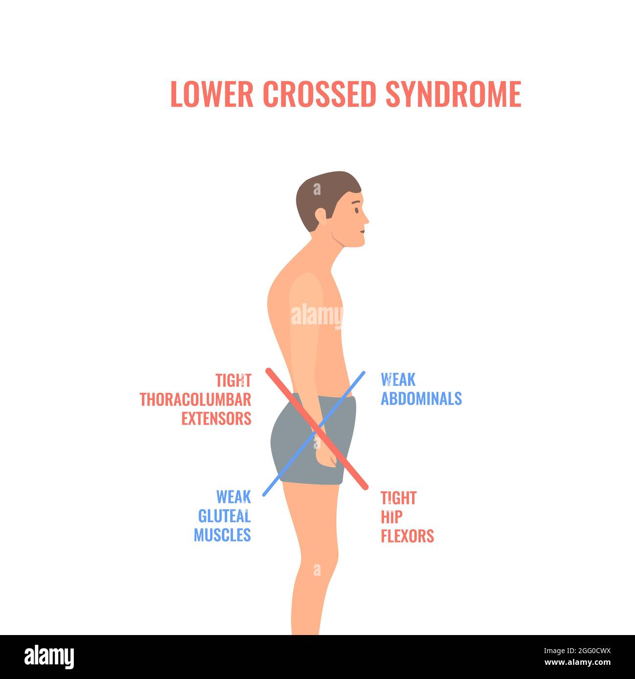 Pelvic Crossed Syndrome Treatment