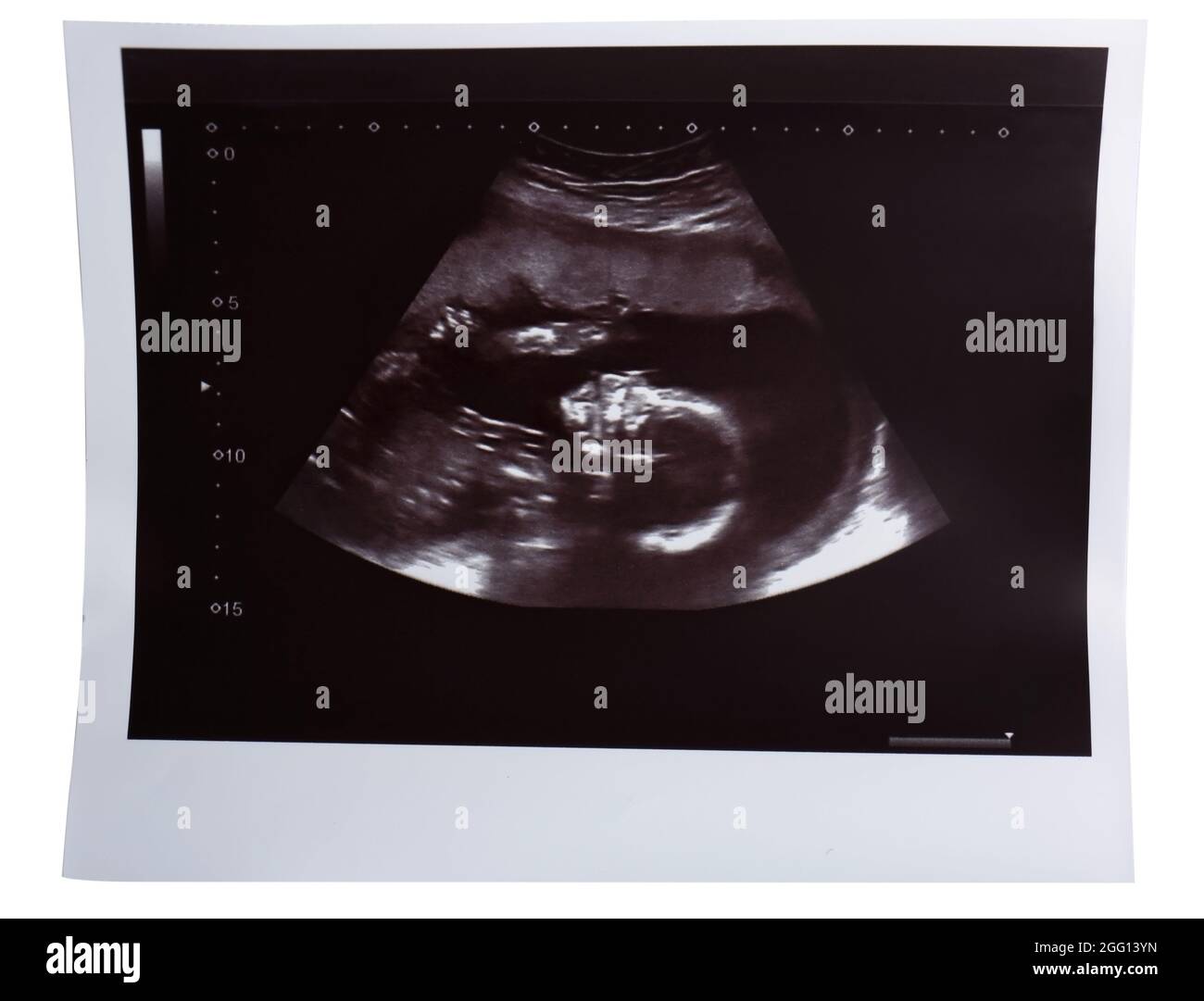 Uterus Scan High Resolution Stock Photography and Images - Alamy