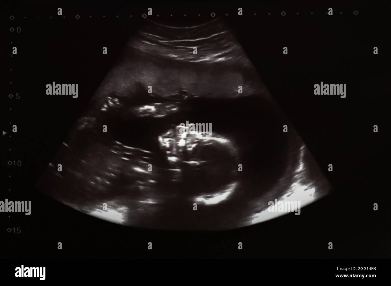 Ultrasound baby scan Stock Photo - Alamy