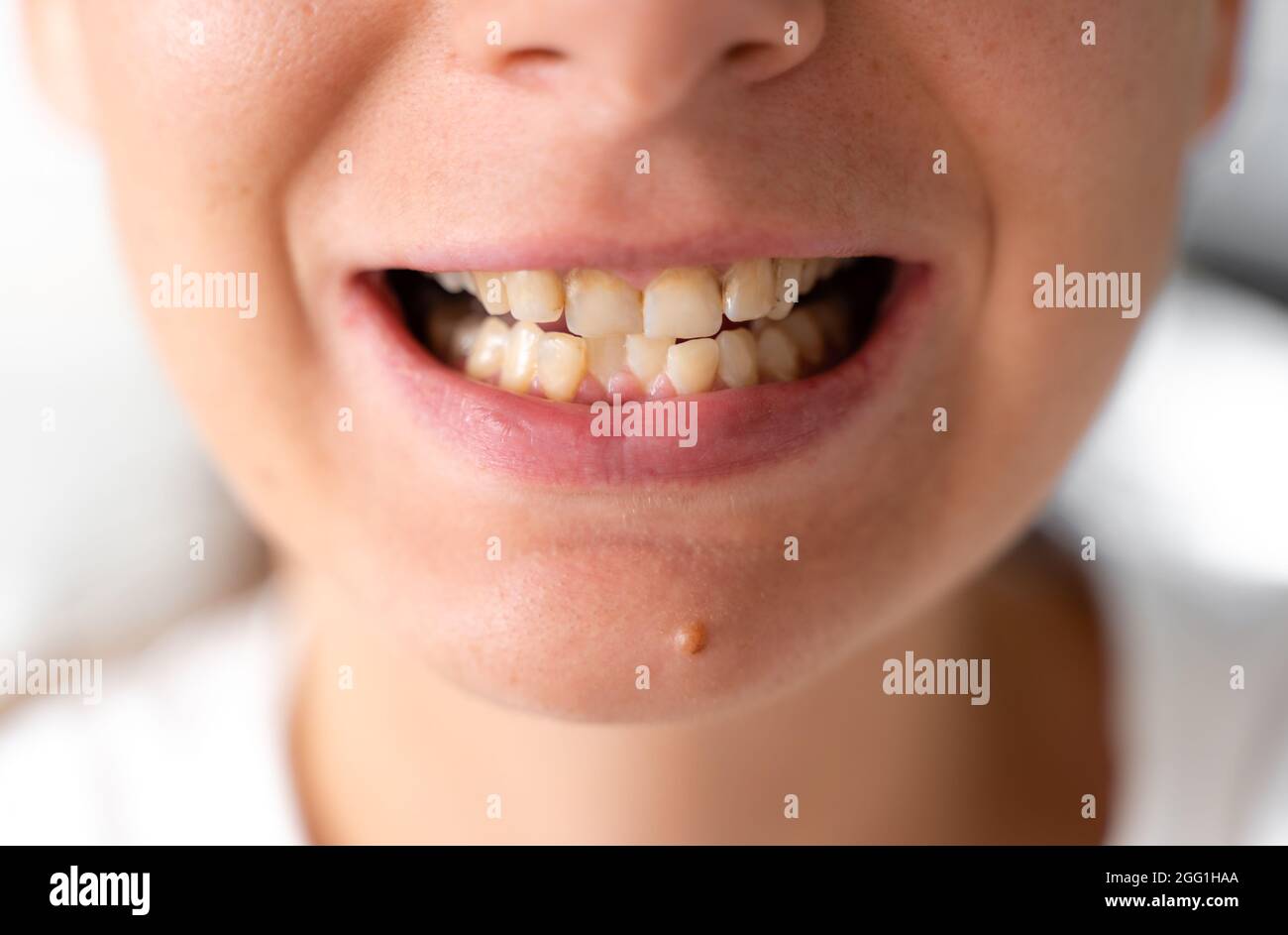 Crooked and yellow teeth. Woman has malocclusion. Adult orthodontics ...