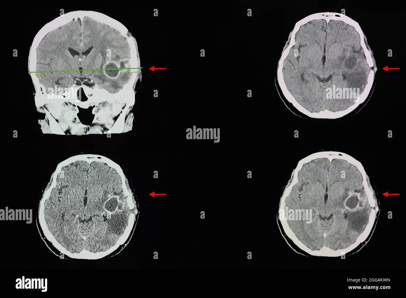 A CT brain scan of a patient with large brain abscesses in her left ...