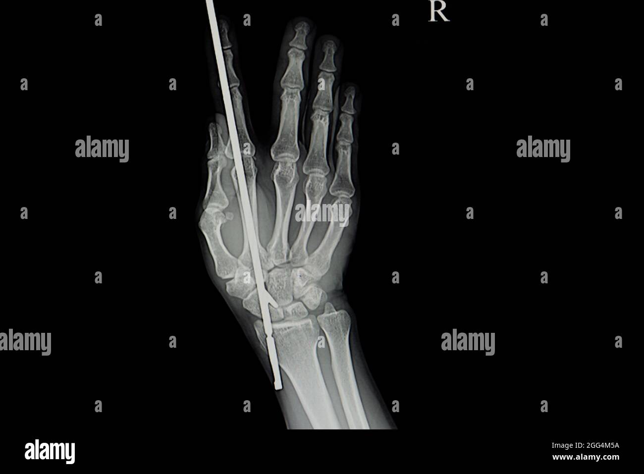 Xray film of a hand of the patient with metallic foreign body impailed ...