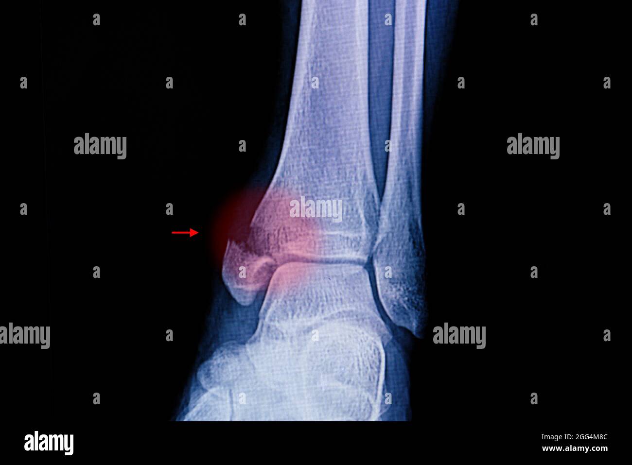 Medial Malleolus Fracture