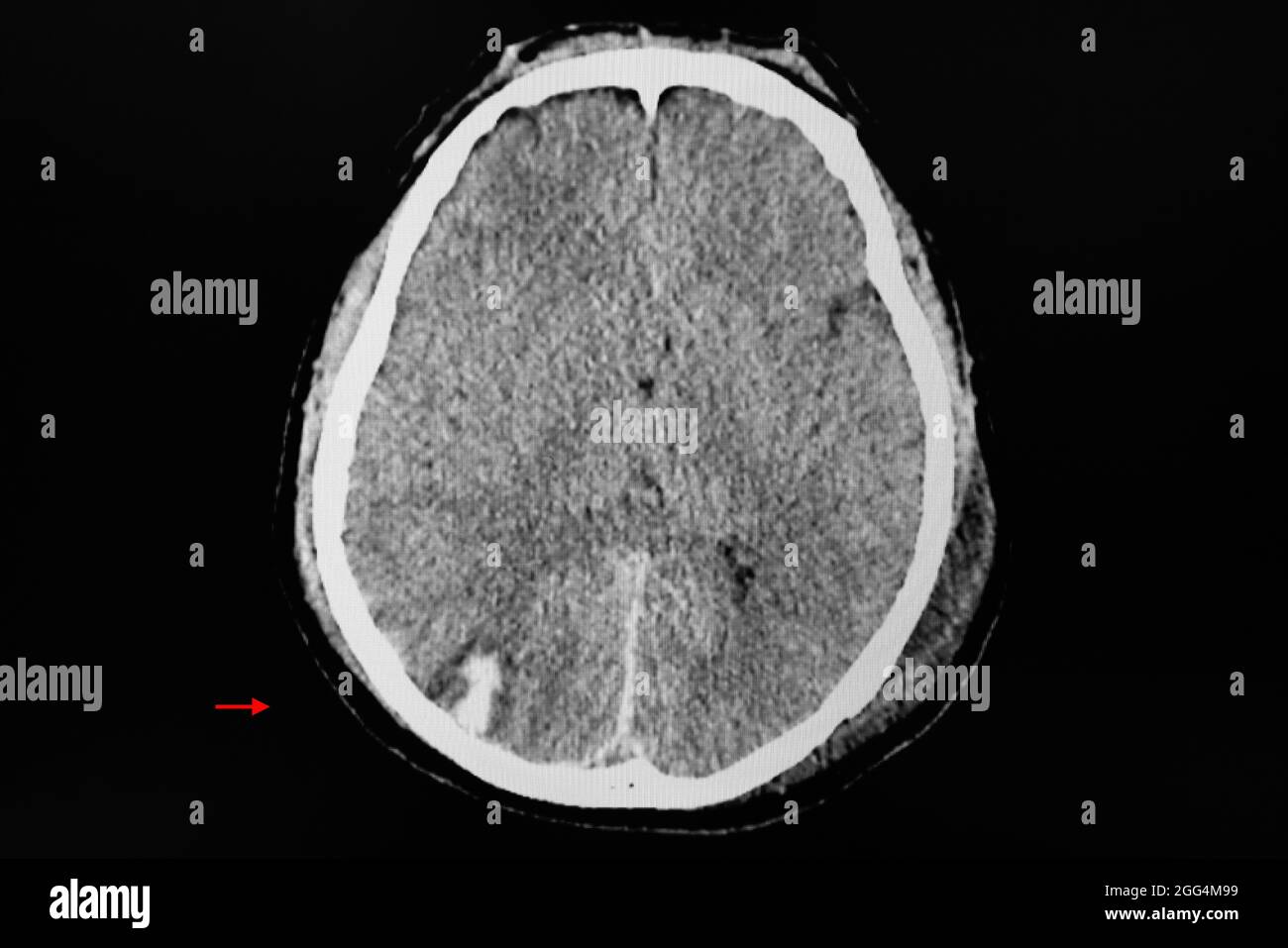 Occiput Scalp Contusion