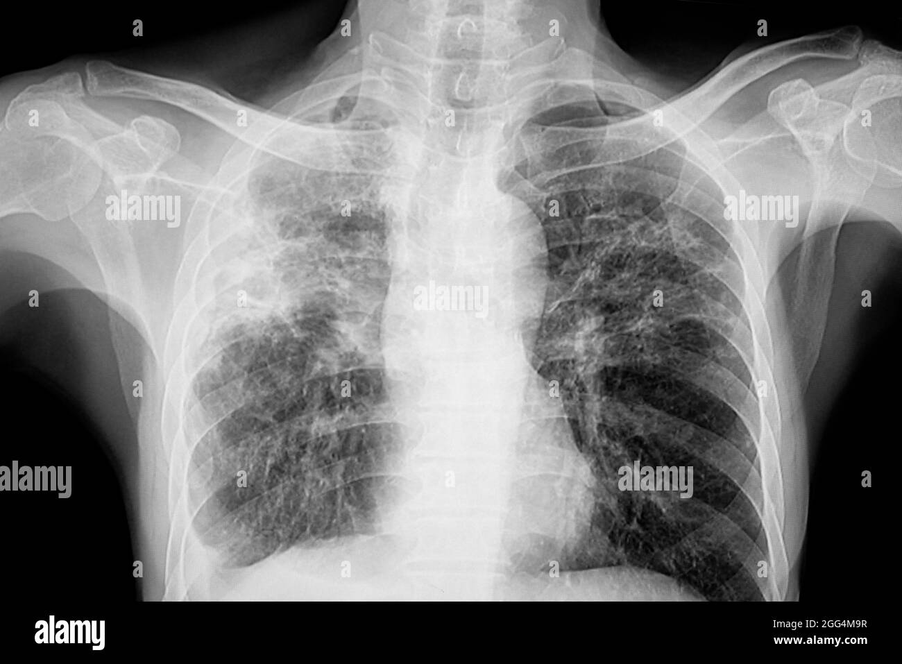 Chest xray of the patient with lungs tuberculosis showing ...