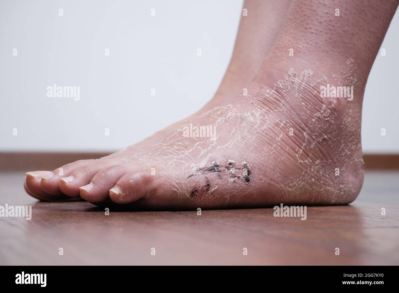 Postoperative suture on the foot, leg after fracture and after removal ...