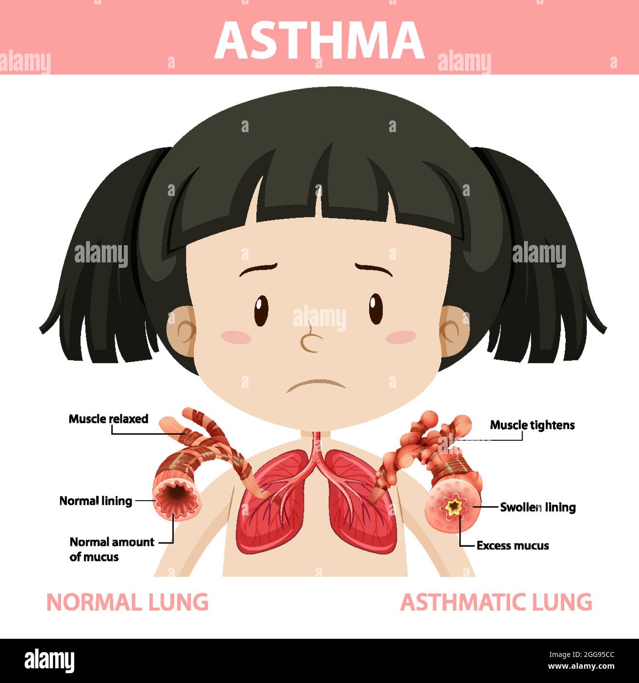 Asthma diagram with normal lung and asthmatic lung illustration Stock ...