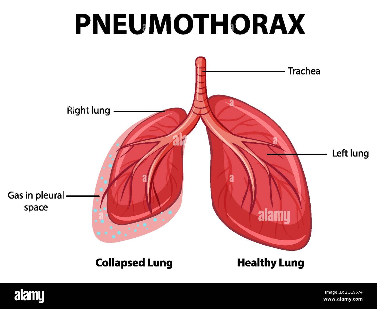 Pneumothorax diagram with collapsed lung and healthy lung illustration ...