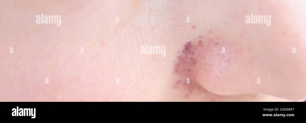 Red cyanotic rash on woman nose closeup Stock Photo - Alamy