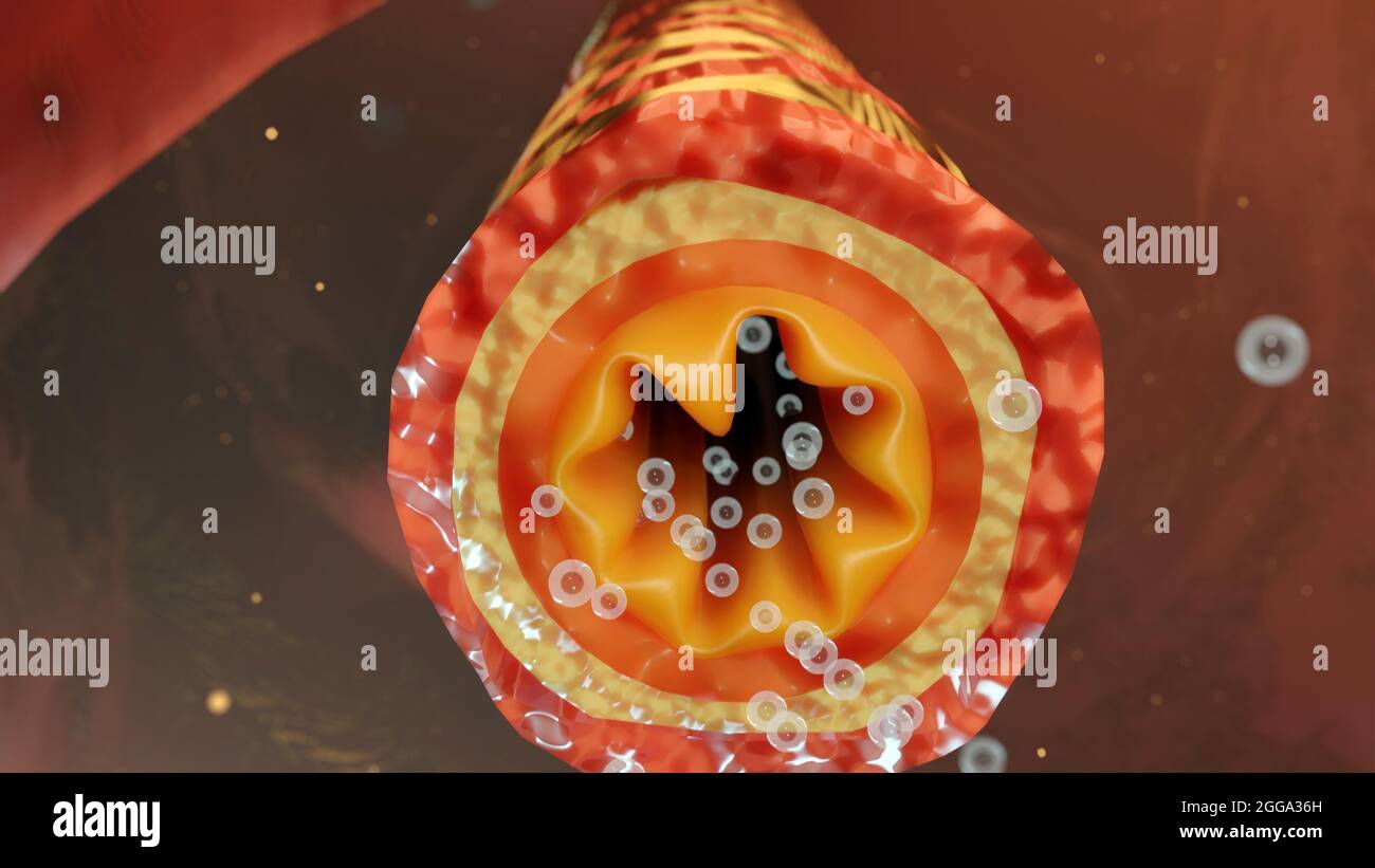 3d Illustration of Asthma Symptoms, Treatment, Bronchiole, 3d render ...