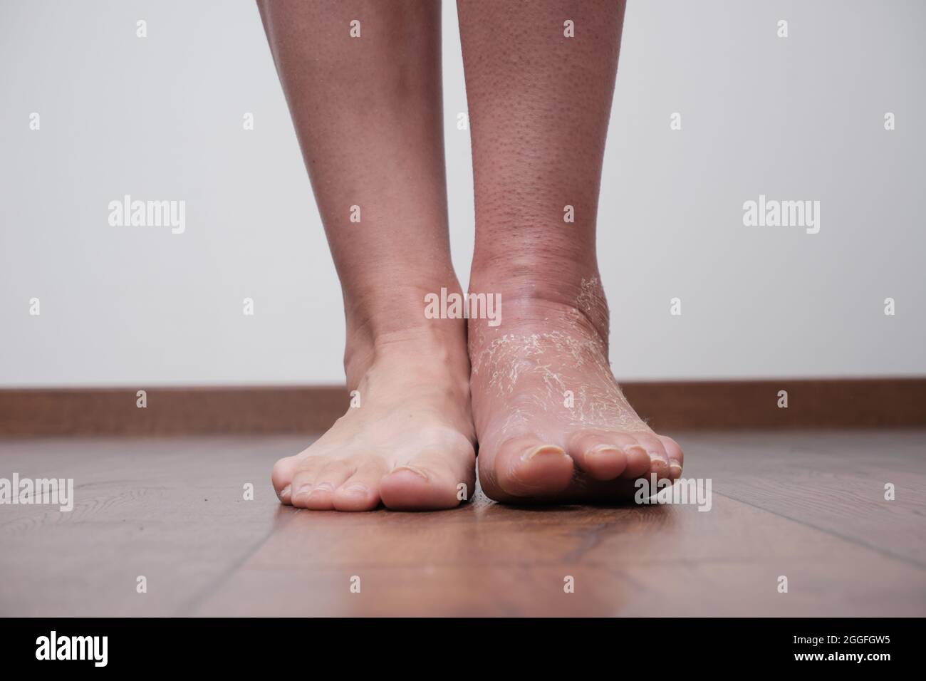 Two legs are on the floor, one leg is healthy, the other leg after a ...