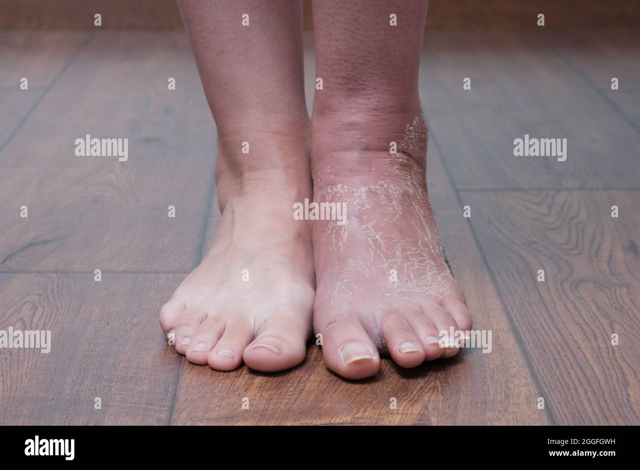 Two legs are on the floor, one leg is healthy, the other leg after a ...