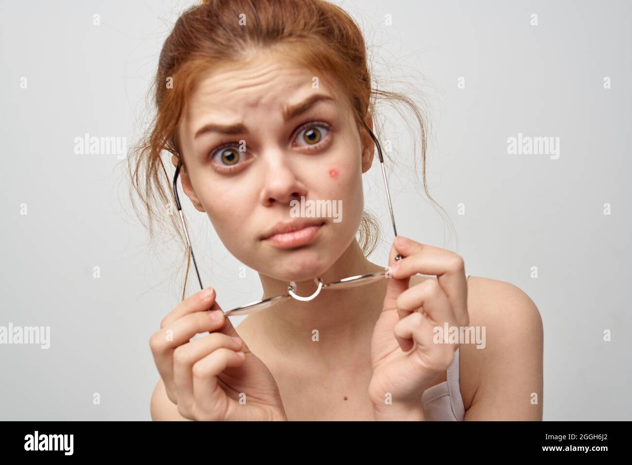 woman face with pimple skin problems close-up Stock Photo - Alamy