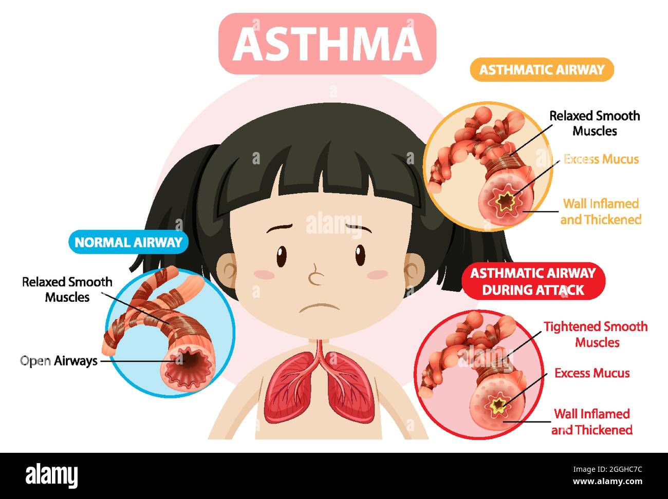 Asthma diagram with normal airway and asthmatic airway illustration ...
