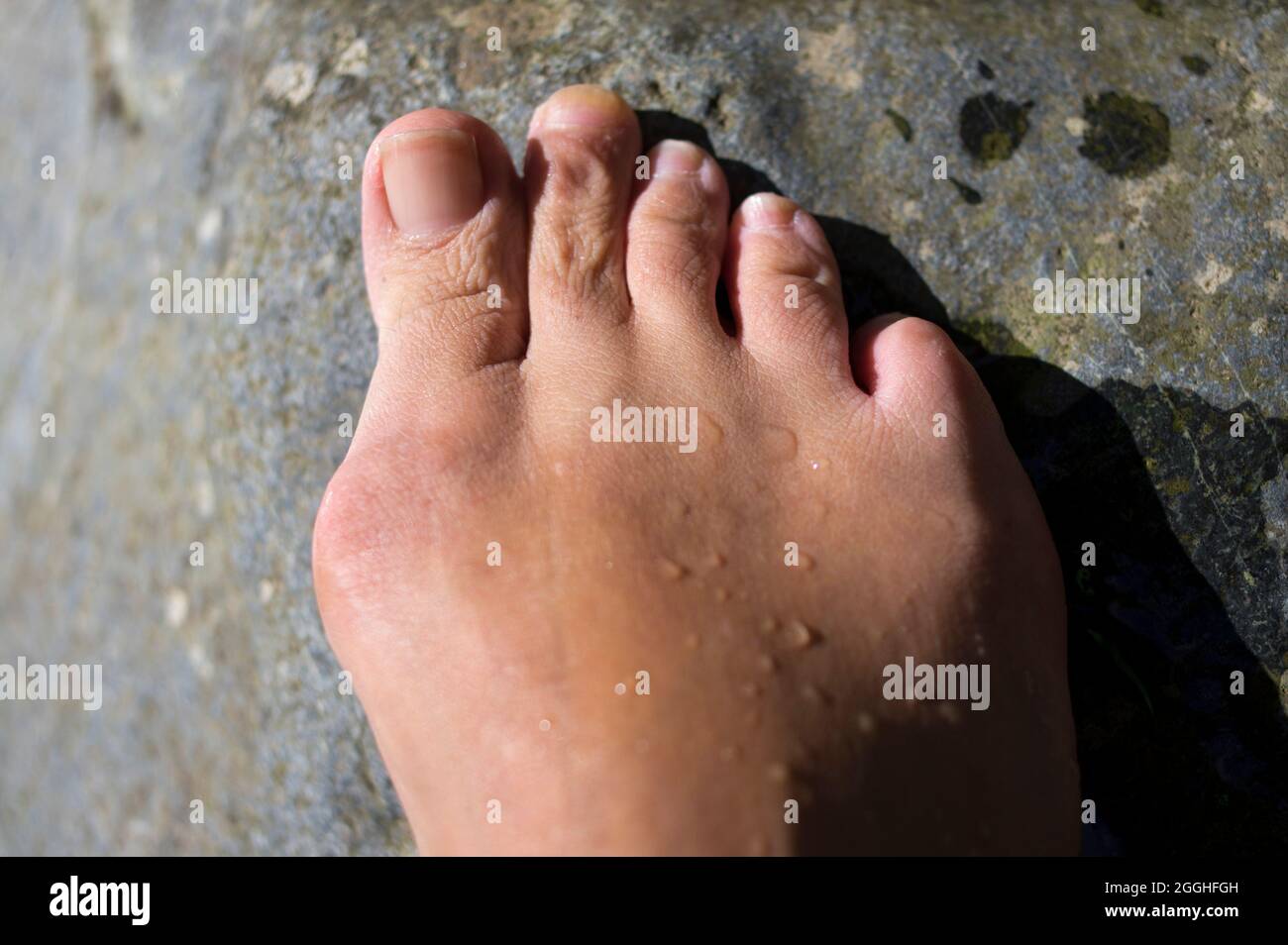 Hallux valgus bunions hi-res stock photography and images - Alamy