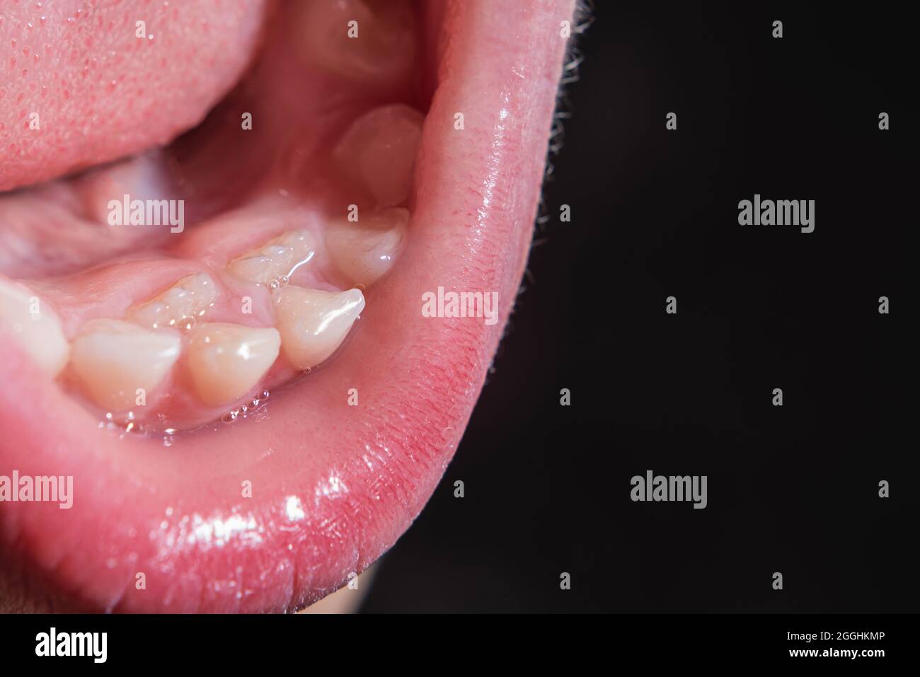 The child's molars are erupting when the milk teeth have not yet fallen ...