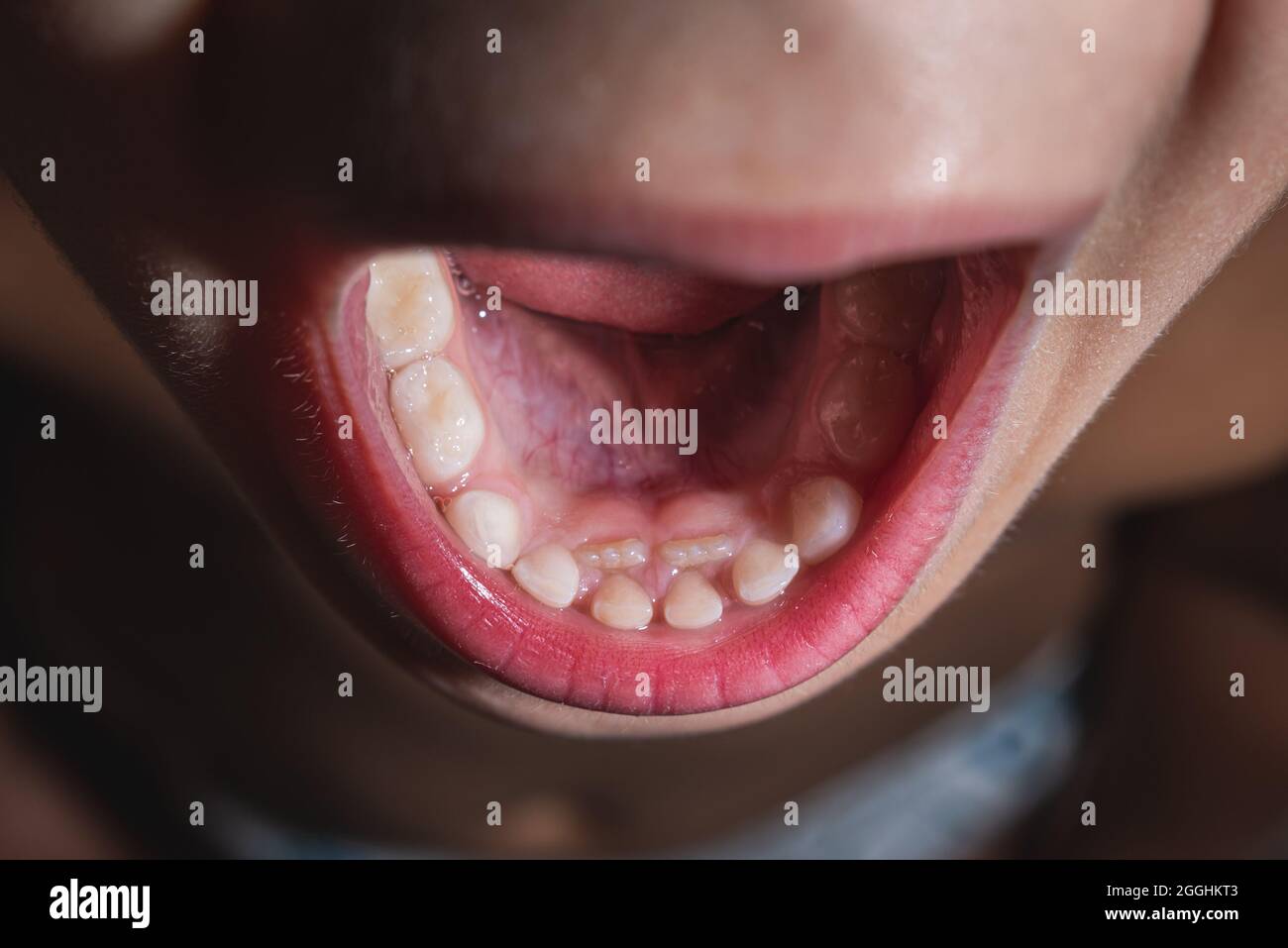 The child's molars are erupting when the milk teeth have not yet fallen ...