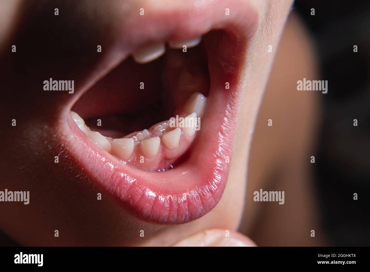 Molars erupting hi-res stock photography and images - Alamy