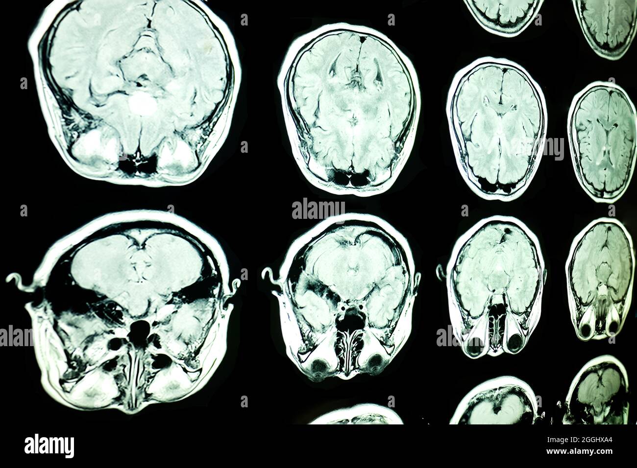 Magnetic resonance images or MRI scan of the brain Stock Photo - Alamy