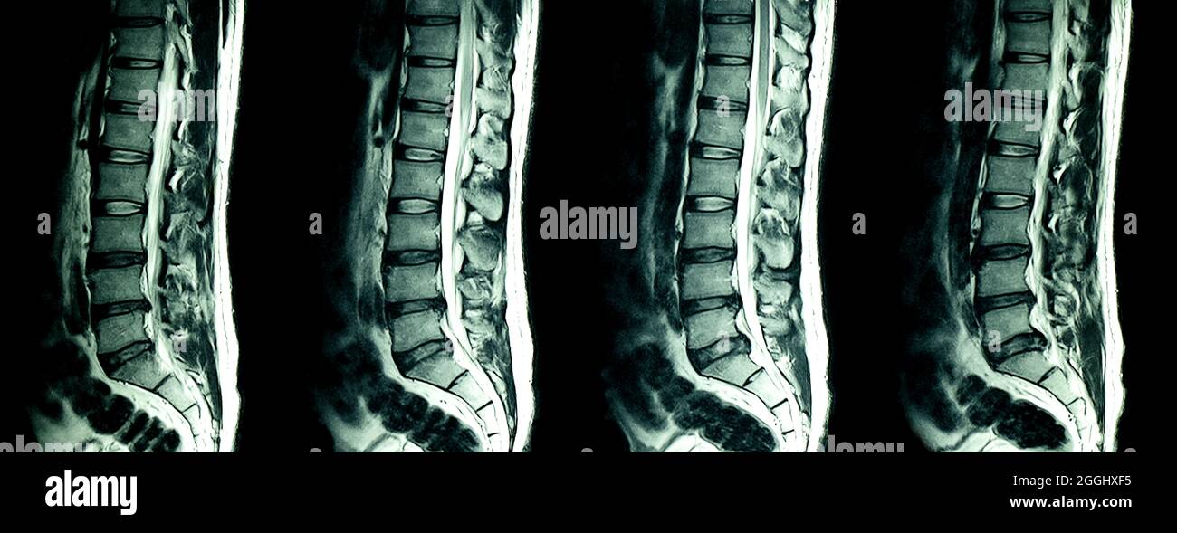 Mri of back pain hi-res stock photography and images - Alamy