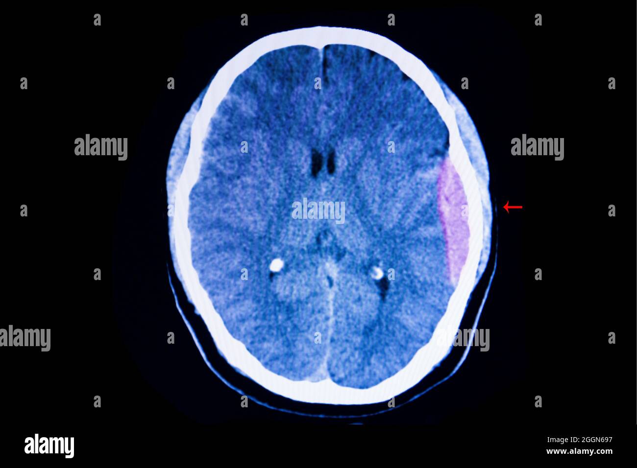 CT scan of the brain of a traffic accident patient showing large ...