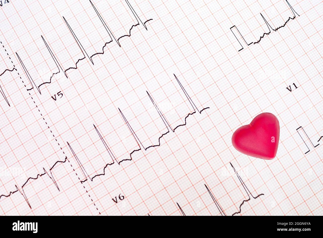 an abnormal electrocardiogram tracing (lateral wall ischemia) and a red ...