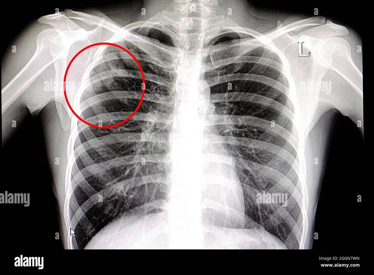 X Ray Chest Tuberculosis