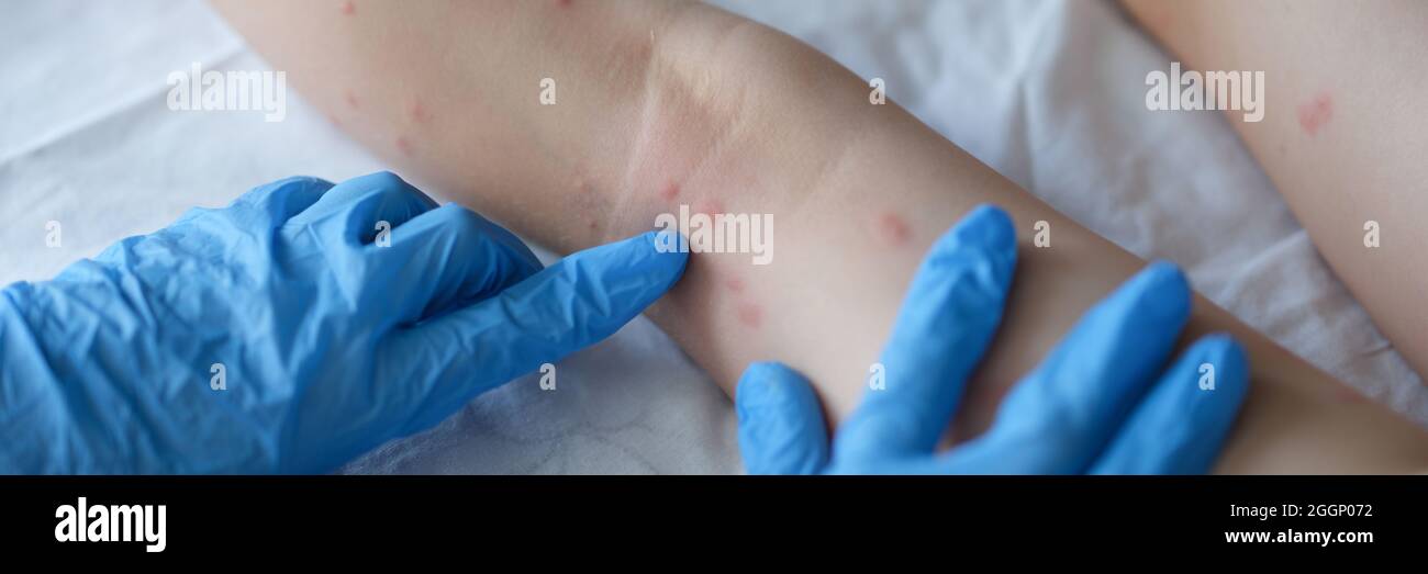 Doctor dermatologist in rubber gloves examining rash on skin of child ...