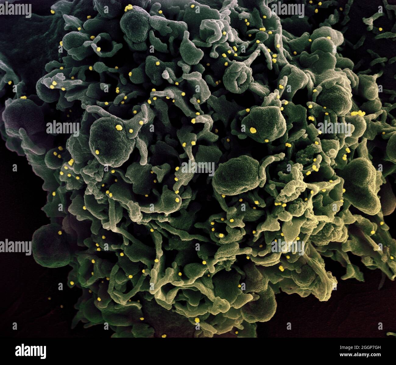 Colorized scanning electron micrograph of a cell infected with SARS-CoV ...
