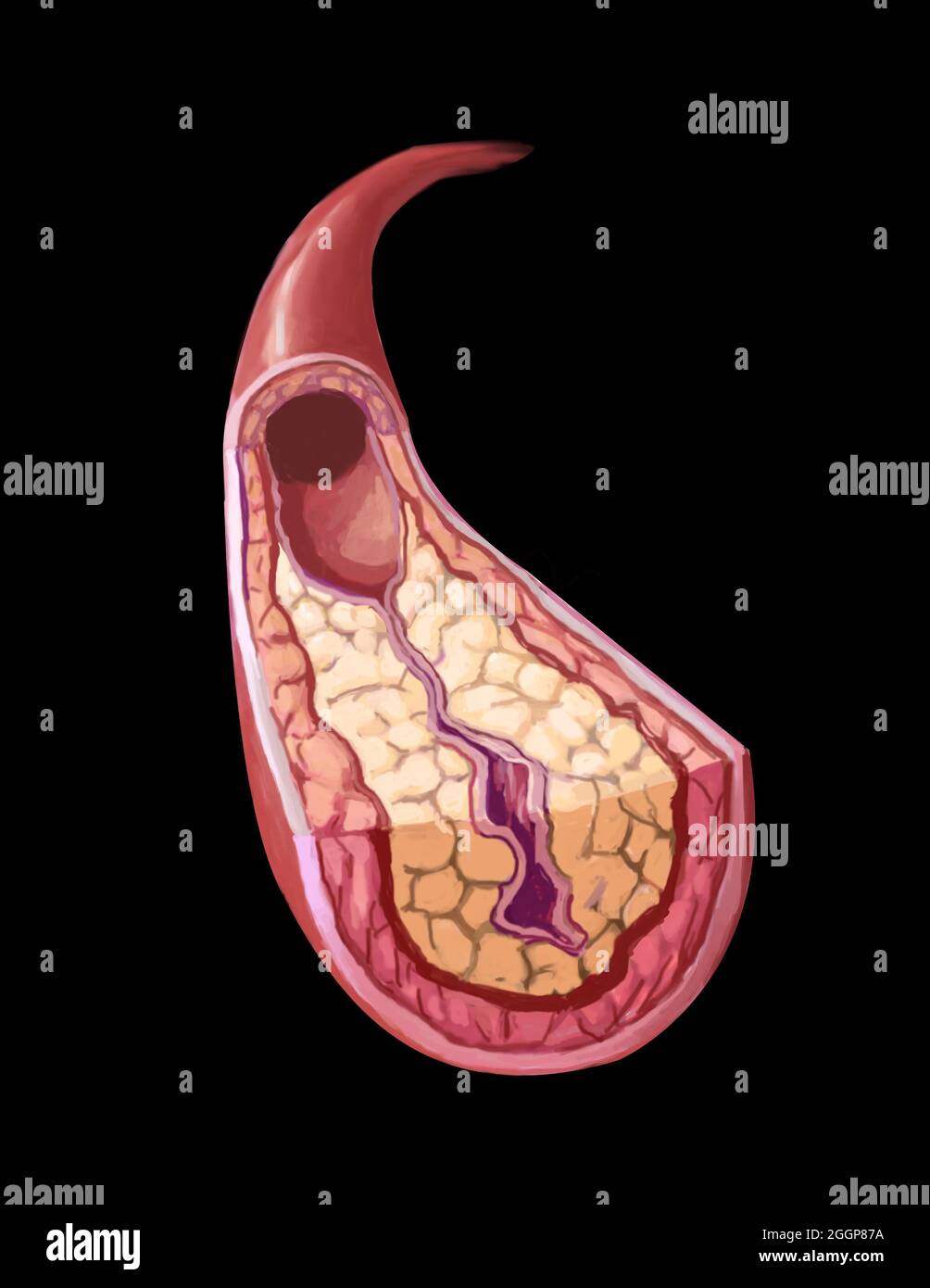 A clogged artery or Atherosclerosis (arteriosclerotic vascular disease ...