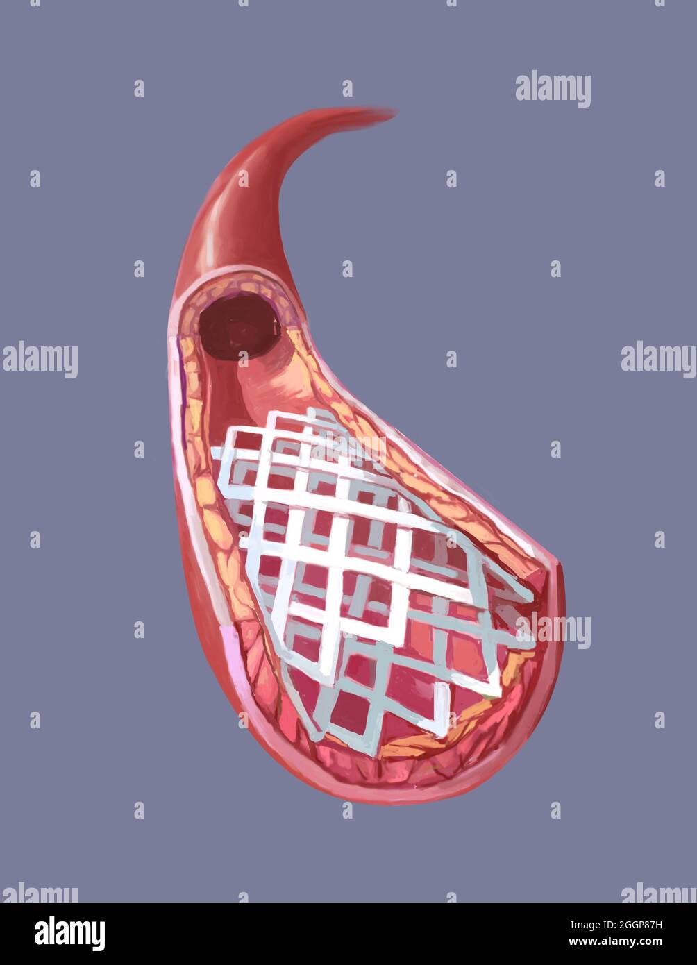 A stent being inserted into a clogged artery due to Atherosclerosis ...