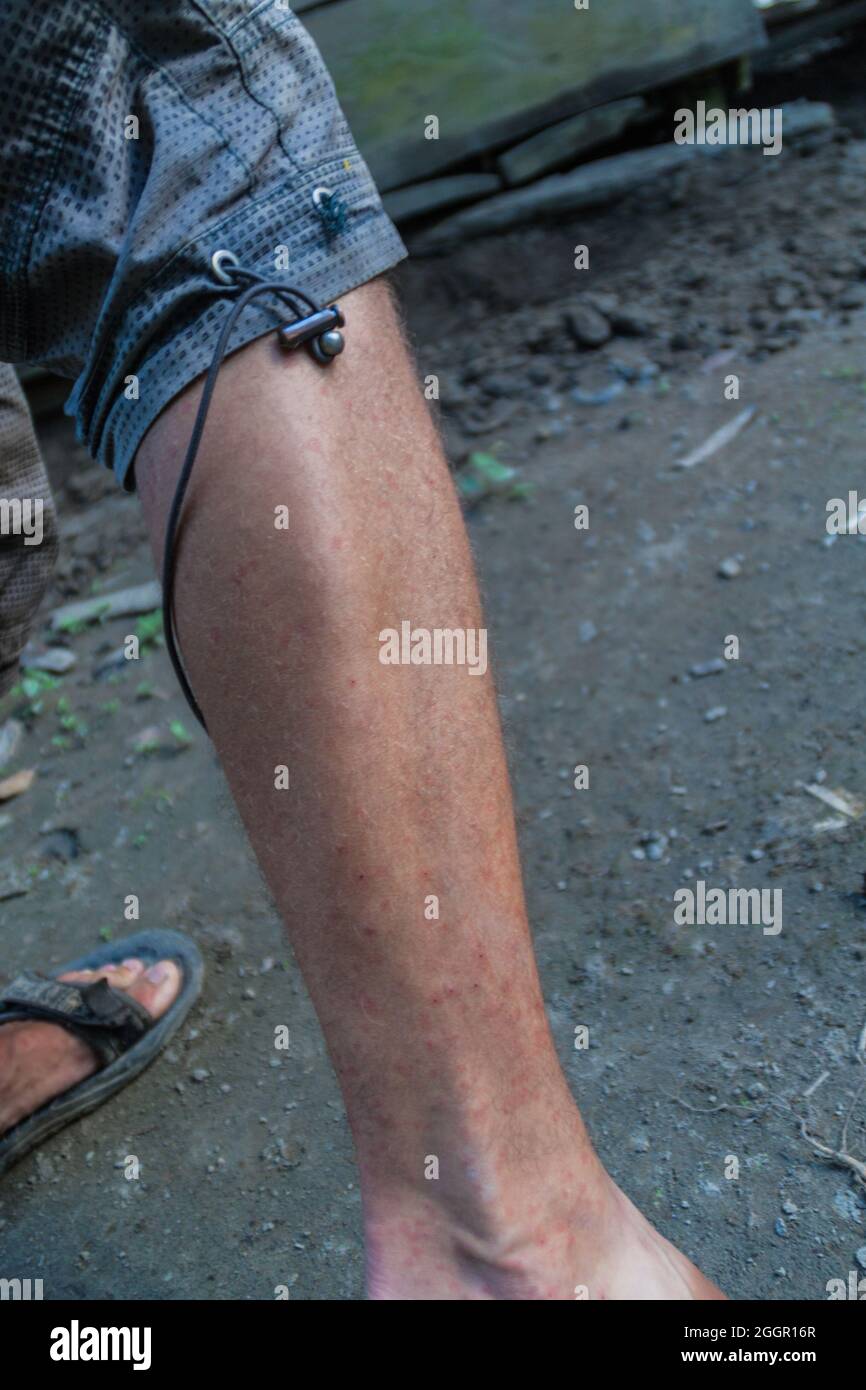 Leg covered by the bites of sandflies, jungle in Peru Stock Photo - Alamy