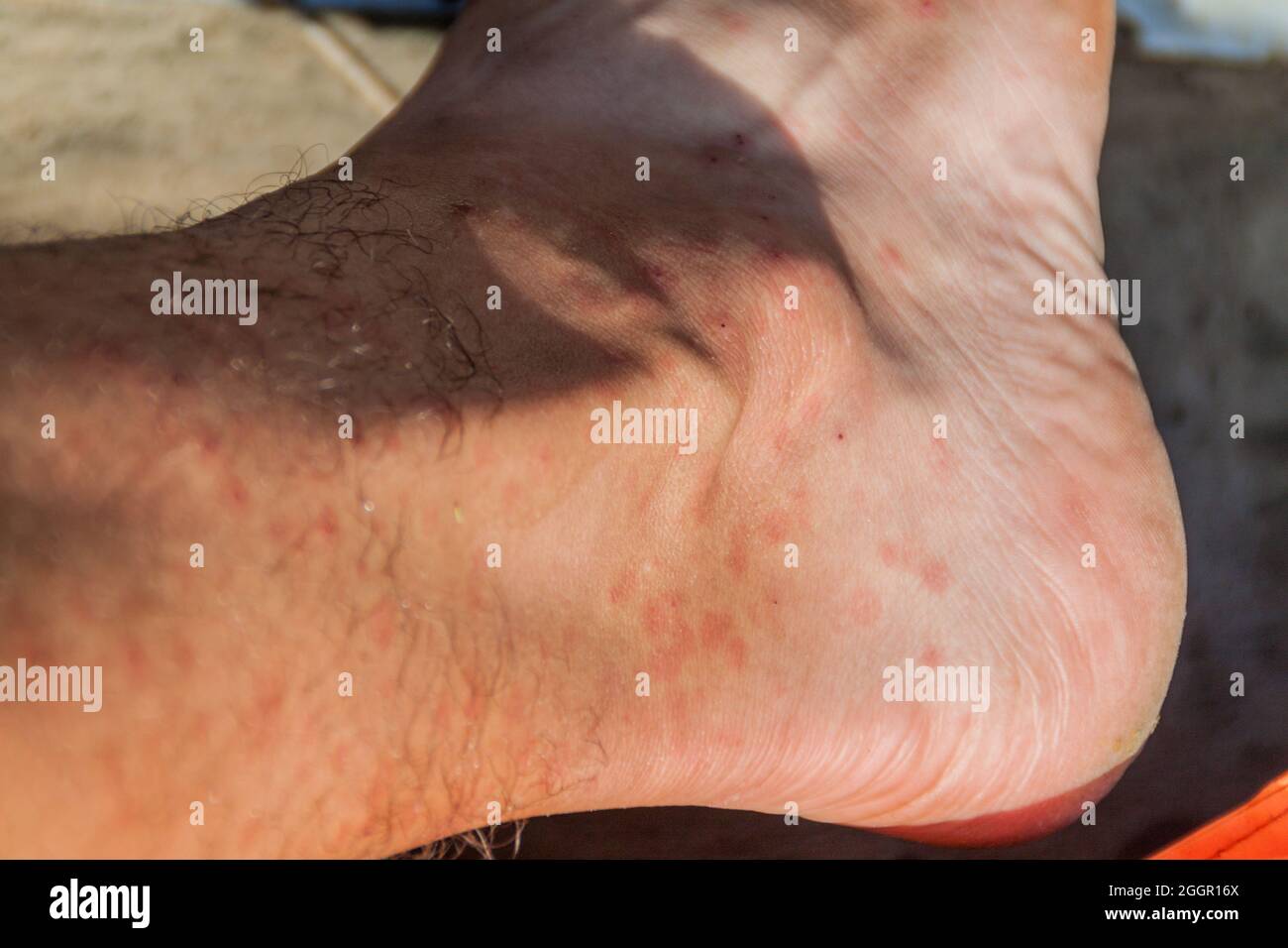 Swollen insect bites hi-res stock photography and images - Alamy