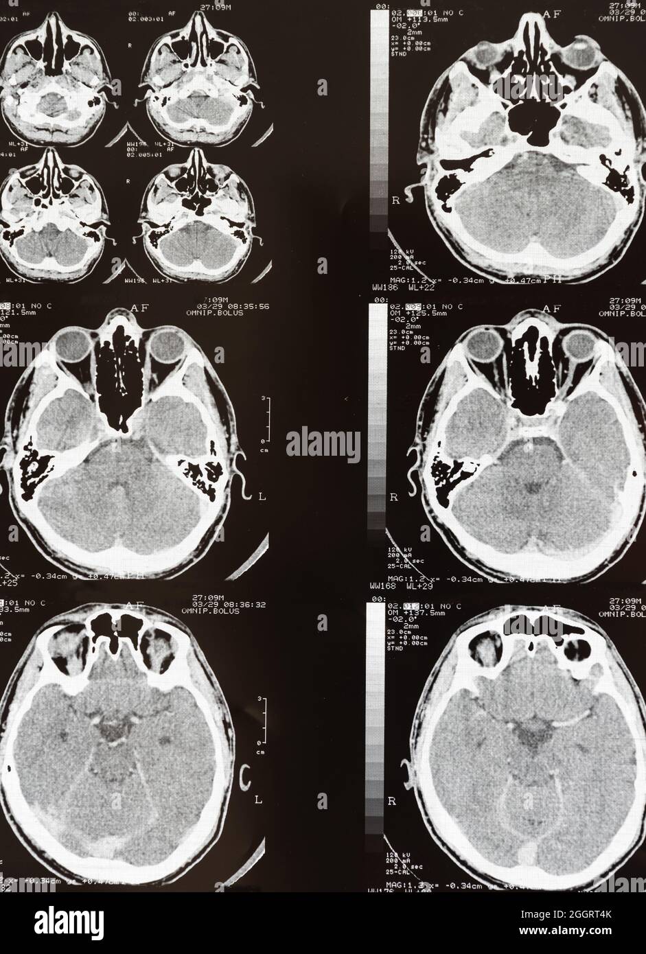 Magnetic Resonance Imaging MRI Of The Human Brain Stock Photo - Alamy