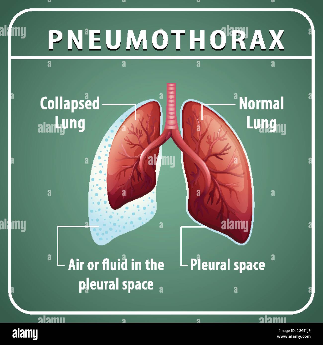 Pneumothorax collapsed lung Stock Vector Images - Alamy