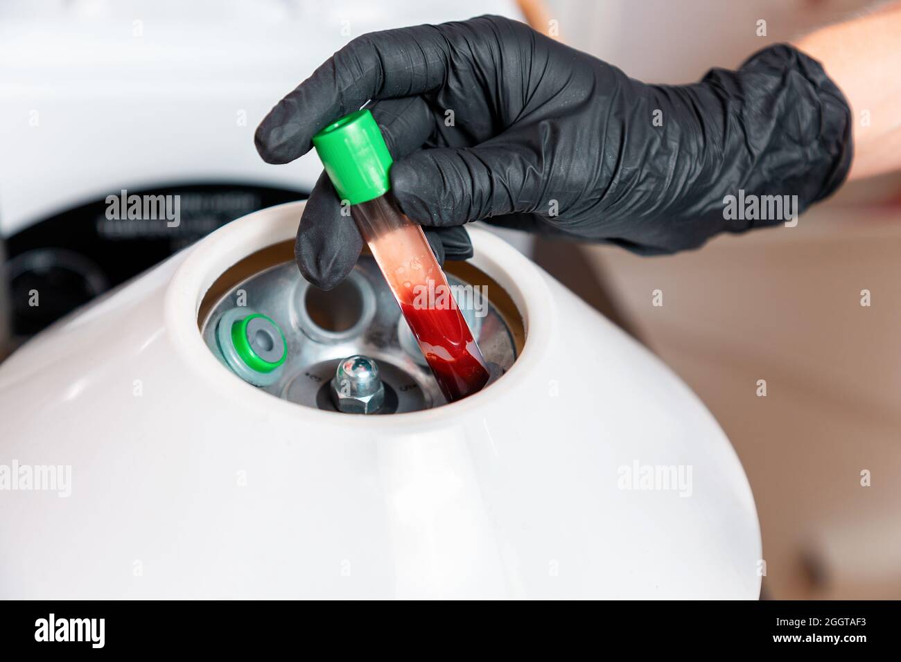 Plasmolifting. Preparation of blood for beauty injections. The ...