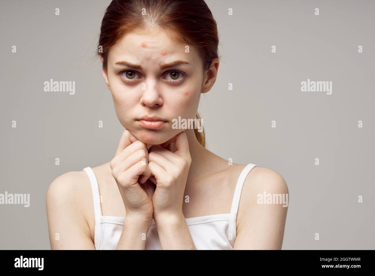 beautiful woman facial skin problems dermatology light background Stock ...