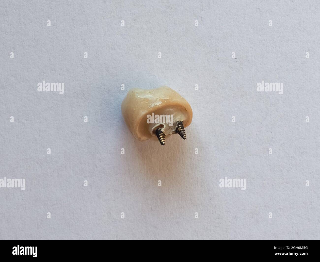 broken failed tooth with metal post and core filling and crown Stock ...