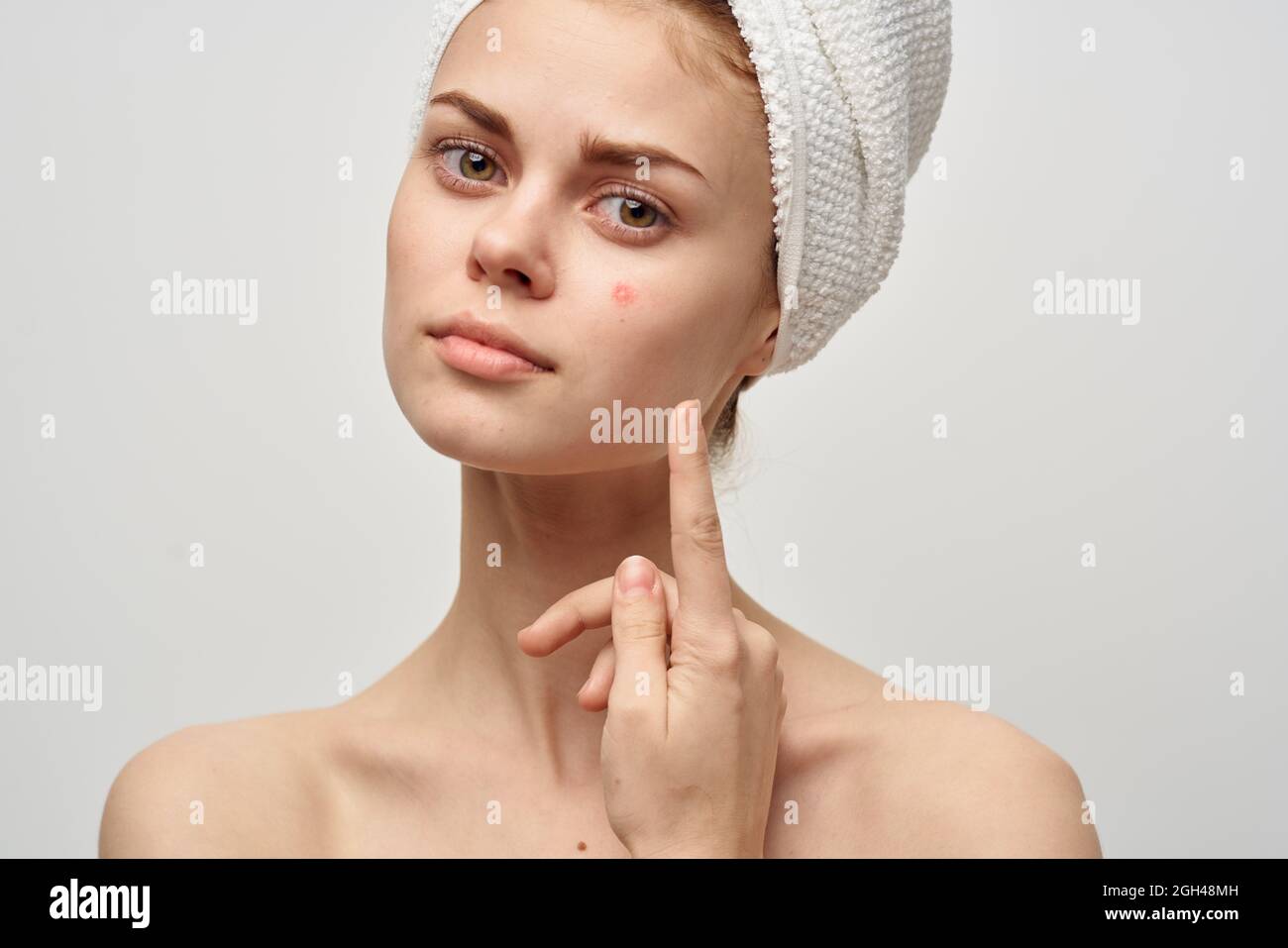 beautiful woman with a pimple on the face cosmetology Studio Stock ...