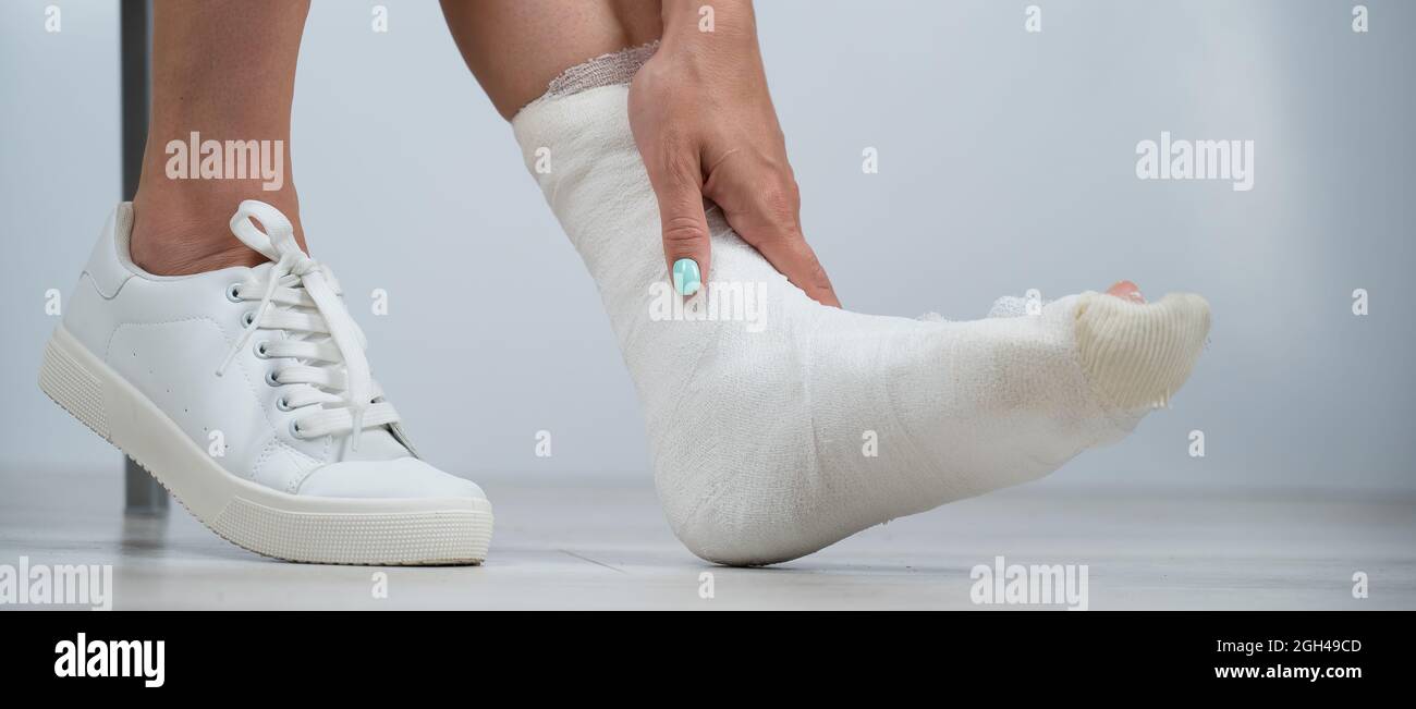 Woman Plaster Cast On Leg High Resolution Stock Photography and Images ...