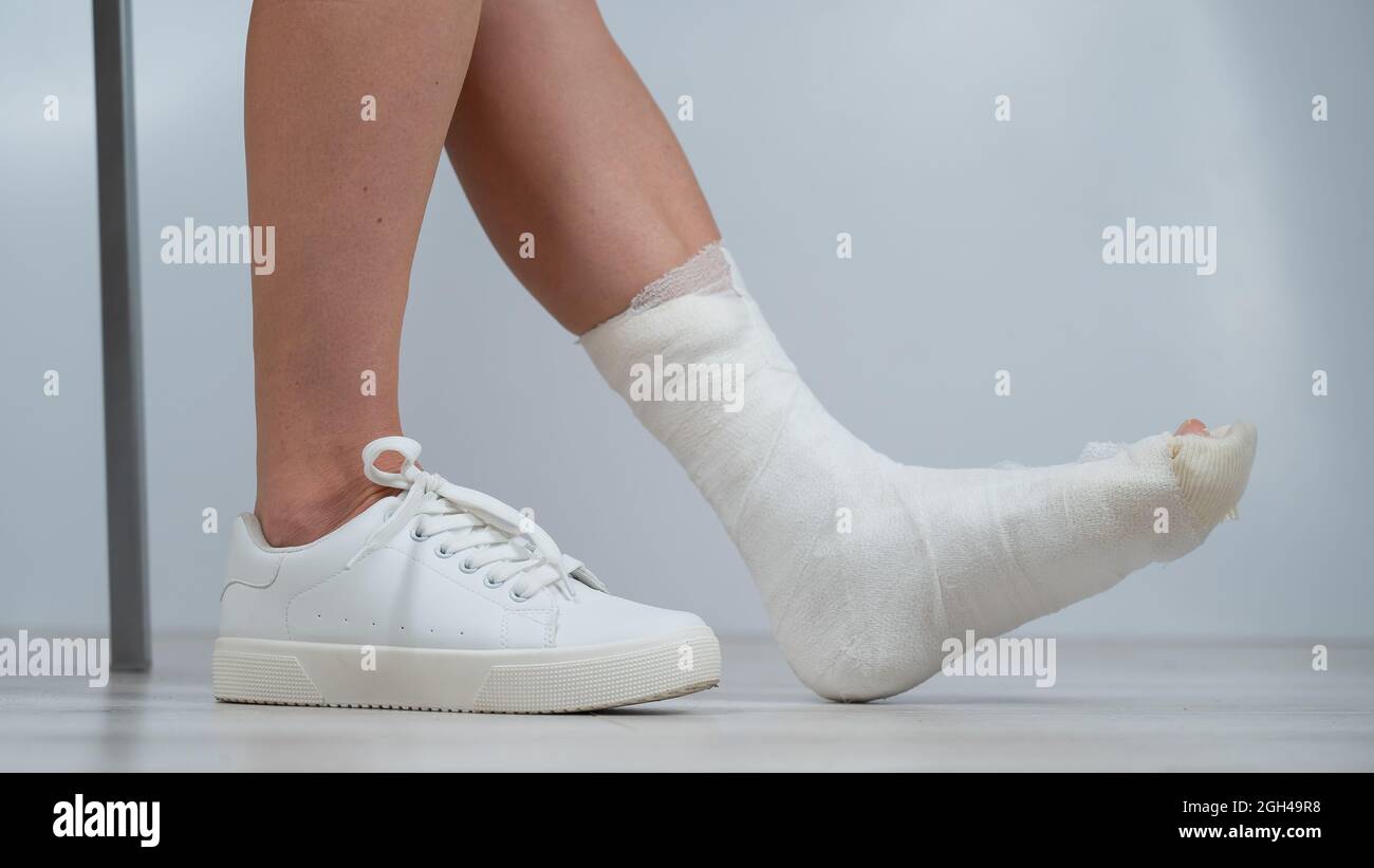 Close-up of female legs with plaster cast. A woman with a broken leg ...