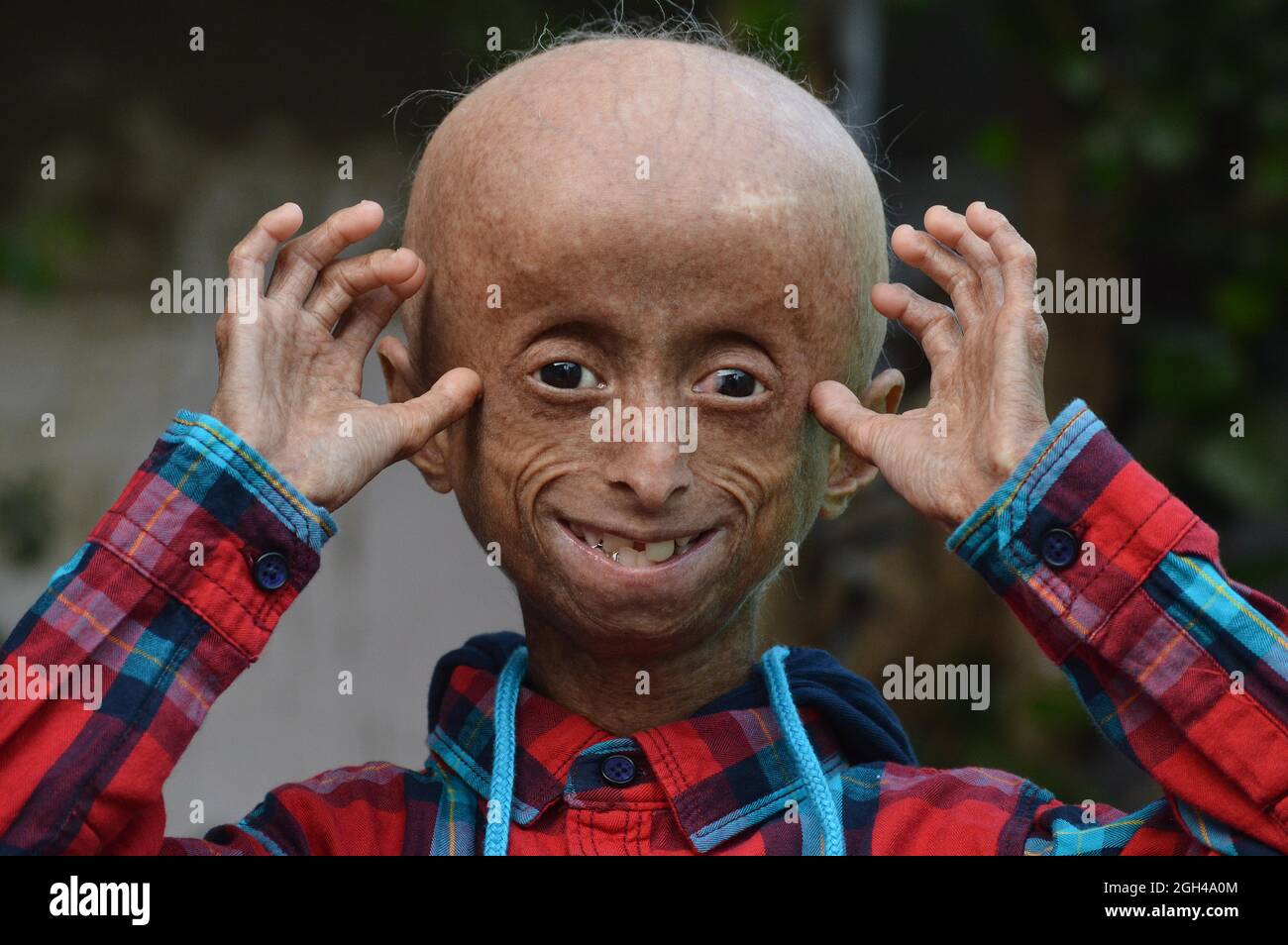 Progeria