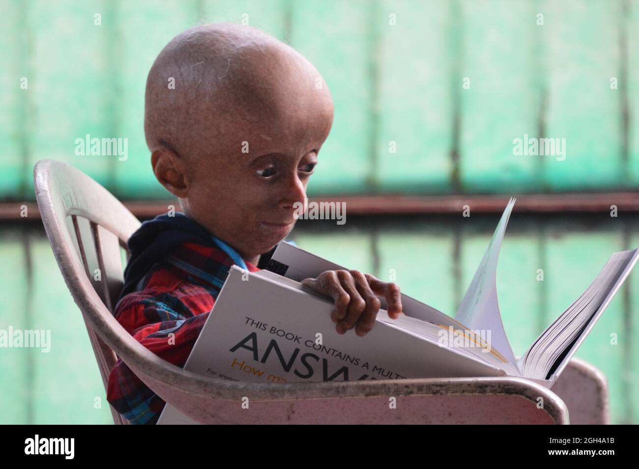 Black Kids With Progeria