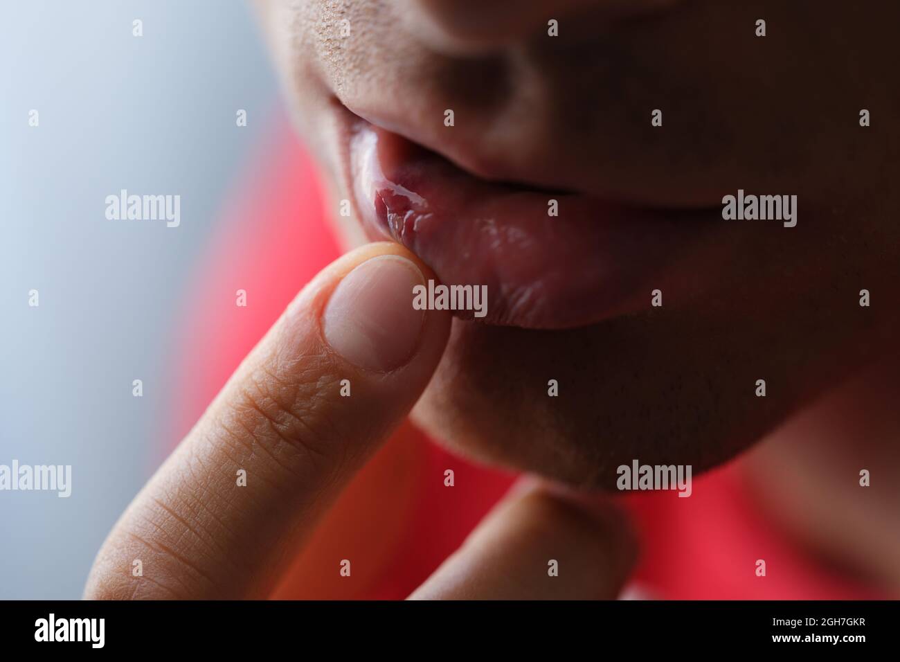 Man holding broken lip with hematoma with his hand closeup Stock Photo ...