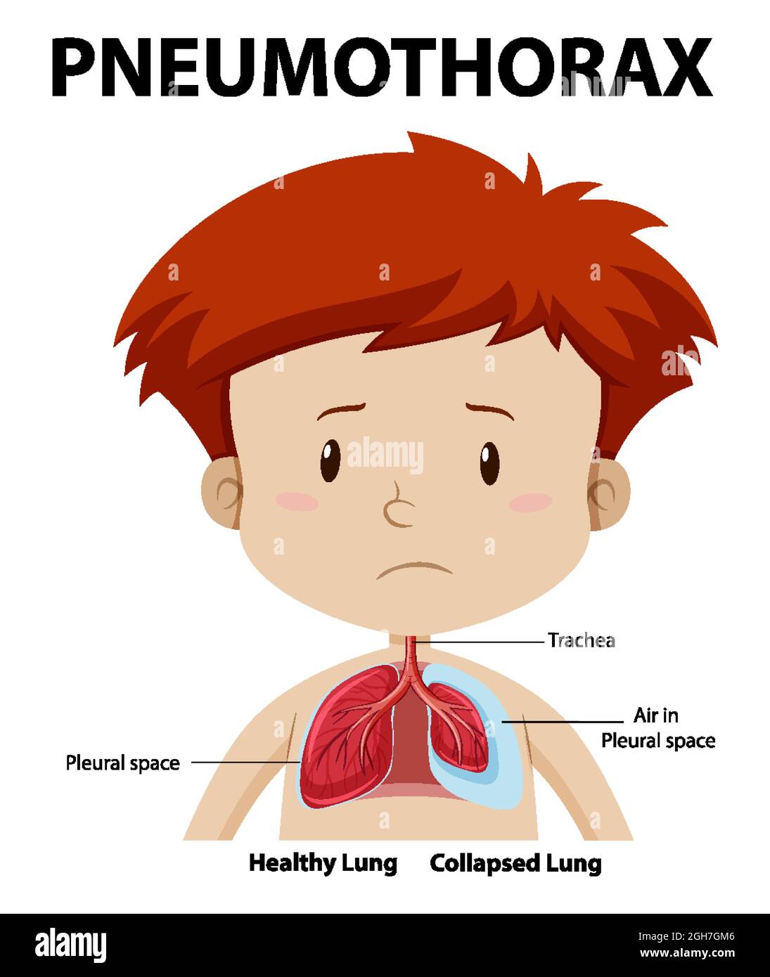 Pneumothorax diagram of human anatomy illustration Stock Vector Image ...