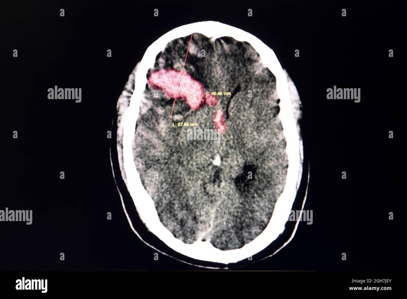 CT scan of the brain of a thrombocytopenic patient with large blood ...