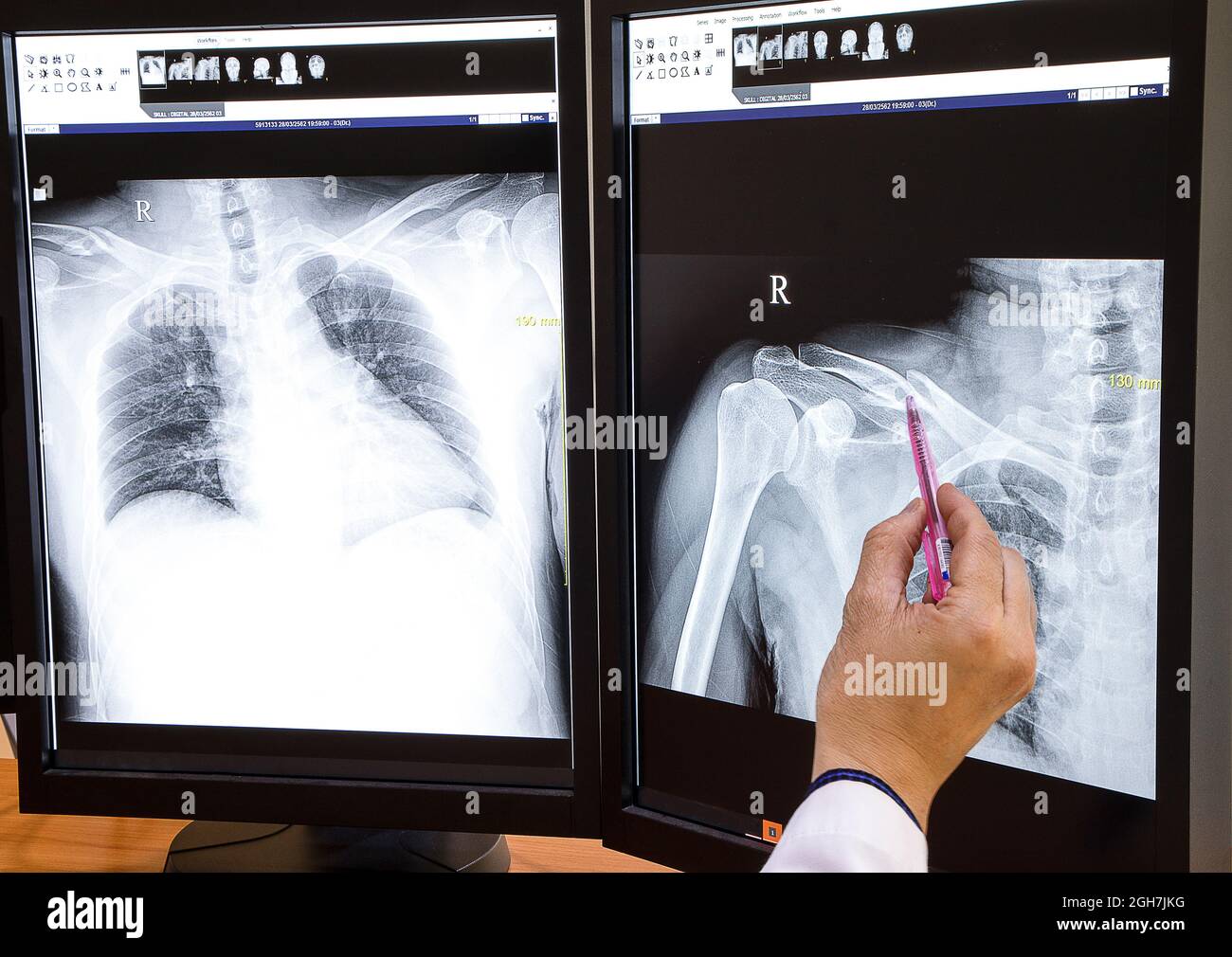 A medical doctor checking at xray images on a large double screen ...
