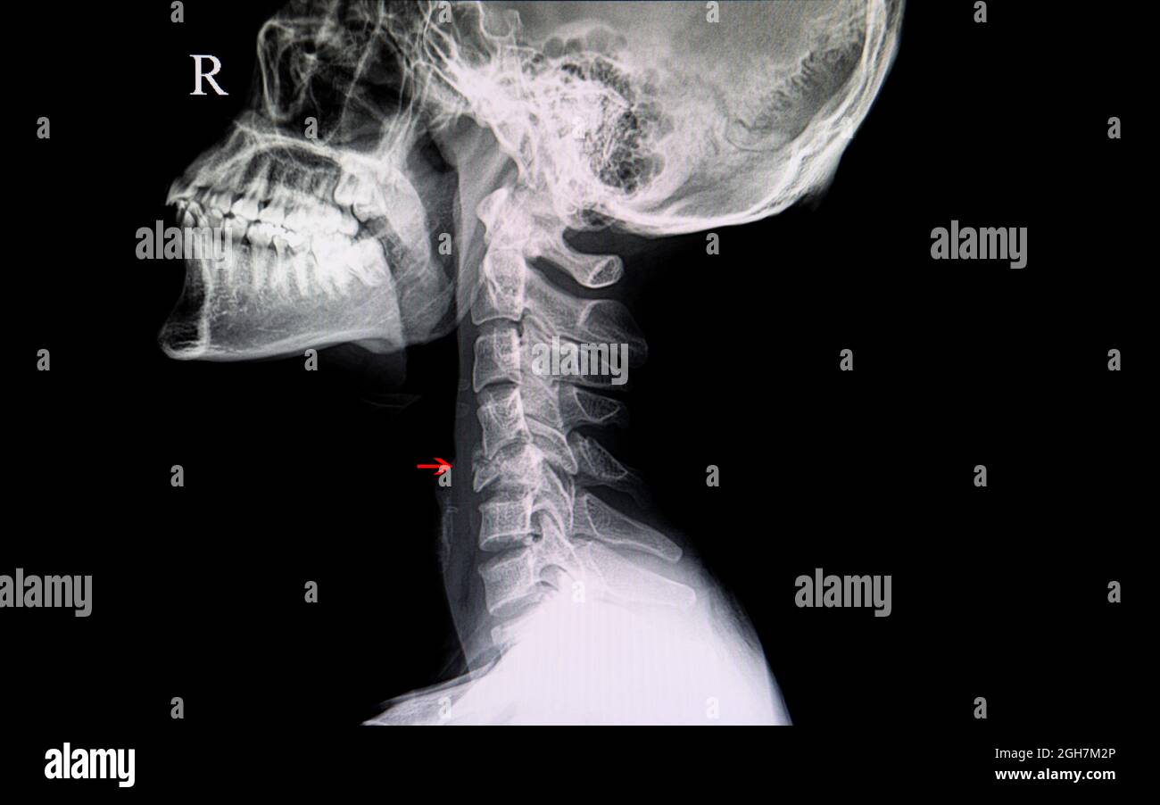 A neck xray image of a patient suffering from car accident showing a ...