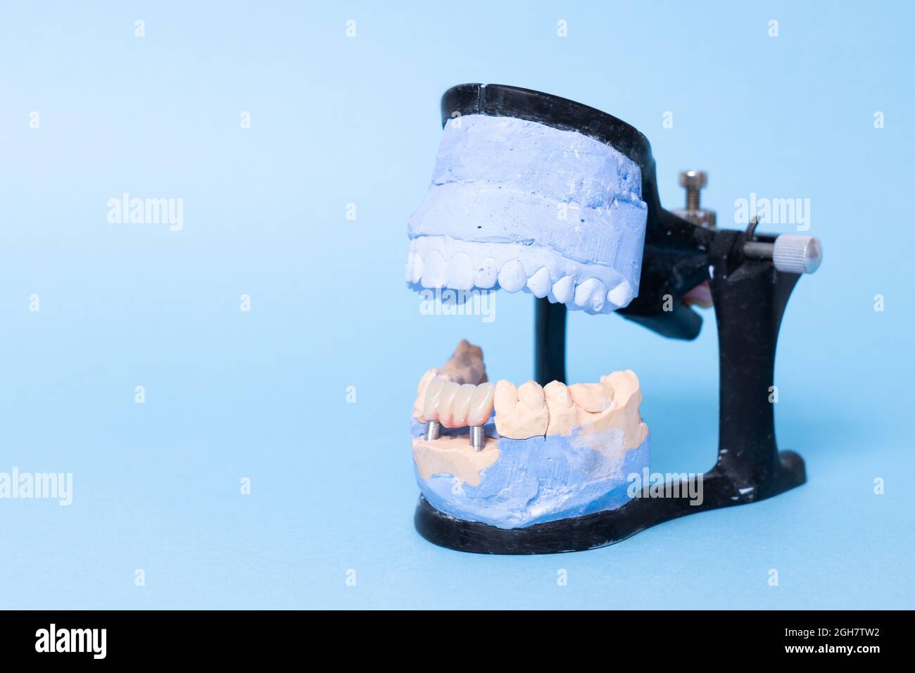 Tooth recovery with implant. Plaster model of teeth. Upper and lower ...