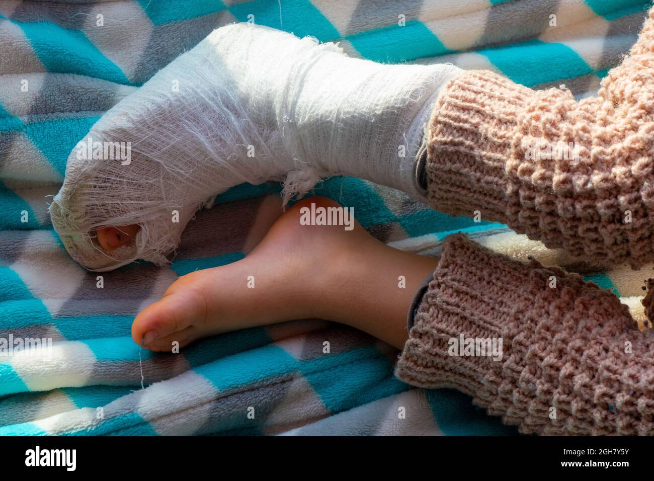 Child with bandage on leg heel fracture. Broken right foot, bone, calf ...